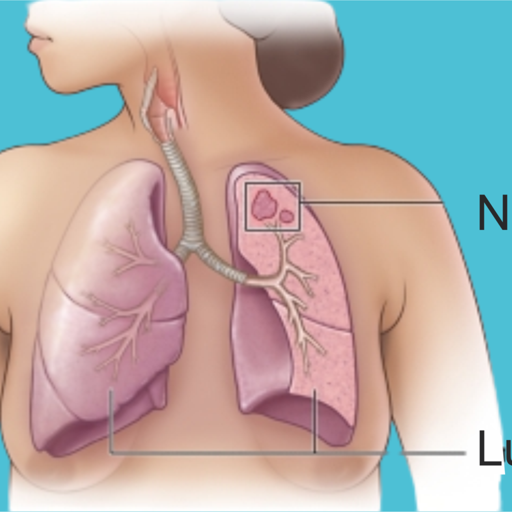 Causes Of Lung Nodules Interventional Pulmonology In Goa And Konkan Dr Prabhu Prasad N C